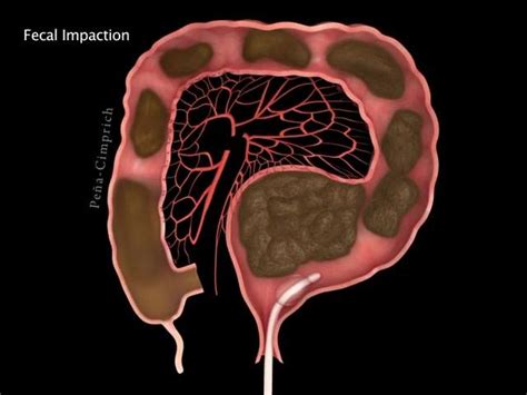 Here Is How Enemas Work For Fecal Disimpaction A Large Amount Of Fluid An Enema Recipe That Is