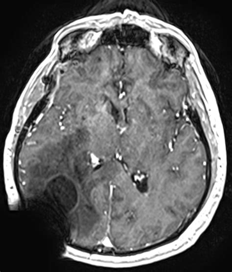 Hydrocephalus Shunt Mri