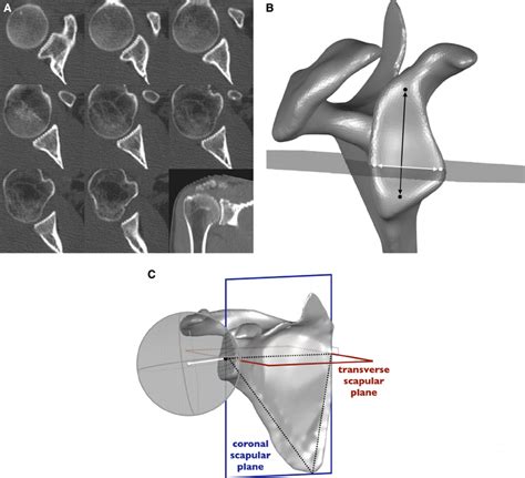 Measurement Of The Glenoid A The Subchondral Bone Of The Glenoid Download Scientific
