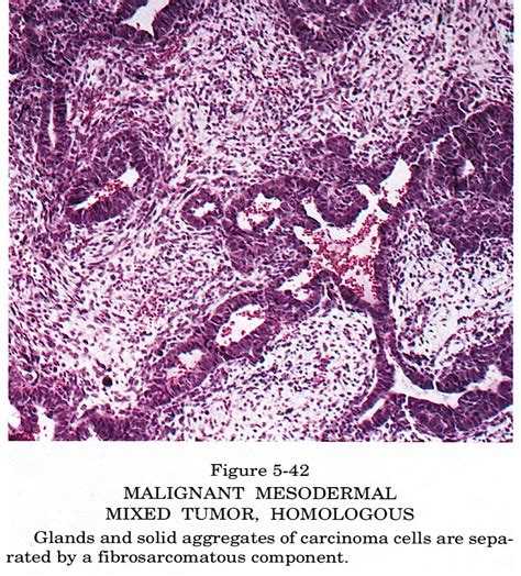 Ovary Tumor Malignant Mixed Mullerian Tumor