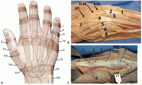 Extensor Tendonitis Hand