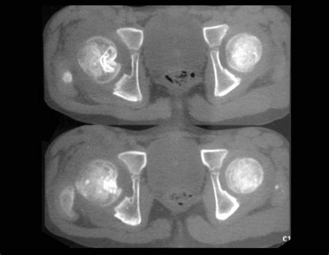 Chondroblastoma Of The Femur Oncosurgery