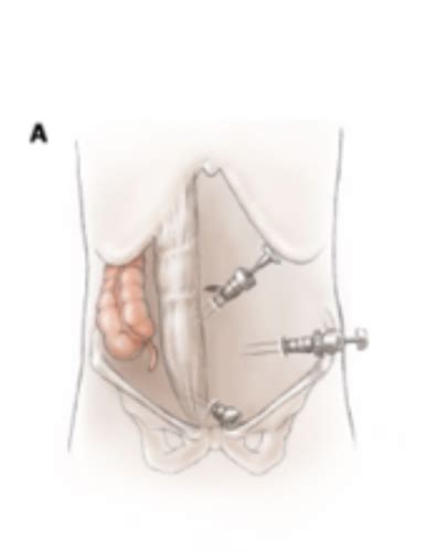 Appendectomy Cholecystectomy Hernia Repair Hemorrhoidectomy Flashcards Quizlet