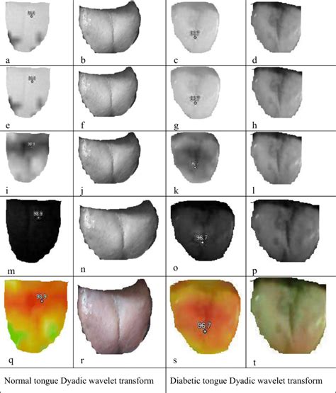 Dyadic Wavelet Transform Of Normal And Diabetic Tongue Download Scientific Diagram