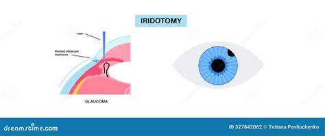 Iridectomy Medical Poster Vector Illustration 328560612