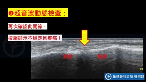 蔡宗穎 醫師 │ 骨科 疼痛科 脊椎矯正 骨盆平衡 增生注射 再生修復 骰骨症候群、骰骨錯位症候群、骰骨脫位錯位、骰骨卡住、cuboid