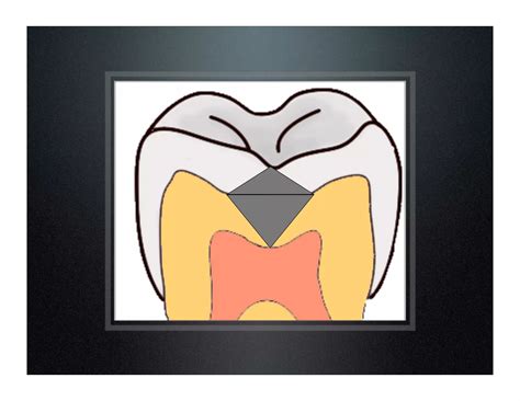 Amalgam Cavity Preparation Class I Pdf