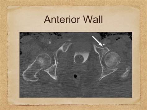 Acetabular Fracture Radiology Xrays Ct Scan And 3d Printing Pptx