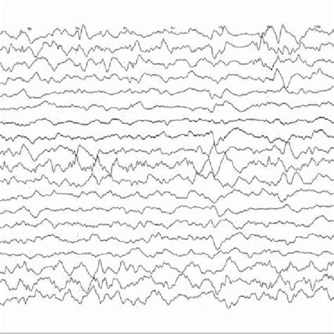 After Treatment Sleep Eeg With Remission Of The Burst Suppression Download Scientific Diagram