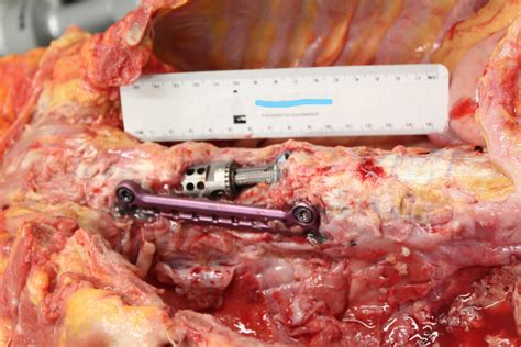 Corpectomy 3rd Eye Forensics Lab Alabama