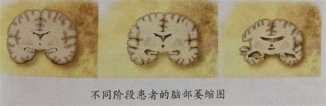 阿尔茨海默病 早中晚期 不同阶段的照护要点认知记忆建议