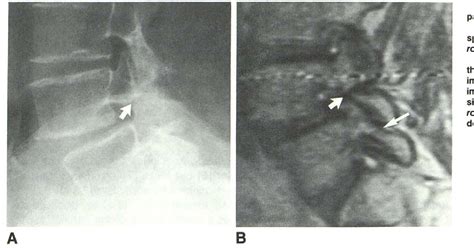 Figure 3 From Mr Imaging Of The Pars Interarticularis Semantic Scholar