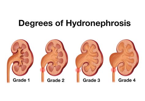 Renal Ultrasound Sonoguide