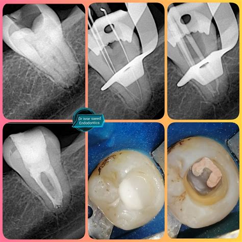 C Shaped Root Canal Lets See The Eighteeth Pakistan