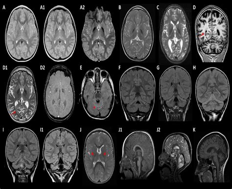 Main Neuroimaging Features A A2 Md 020 Glb1 Axial Tse Turbo Spin Download Scientific