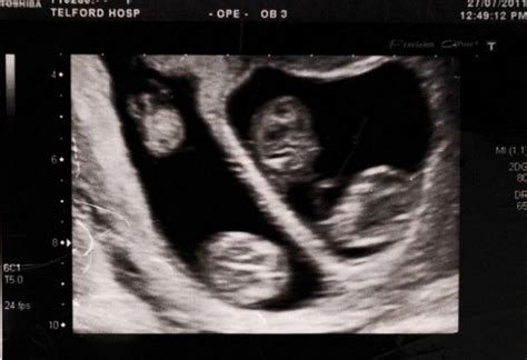 19 წლის გოგონა მუცელში ტყუპებს ატარებდა ექოსკოპიამ უჩვენა თუ რა იმალებოდა პაწიების ზურგსუკან