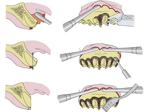 Alveoloplasty Reshaping The Jawbone After Tooth Extraction • Toothandgo
