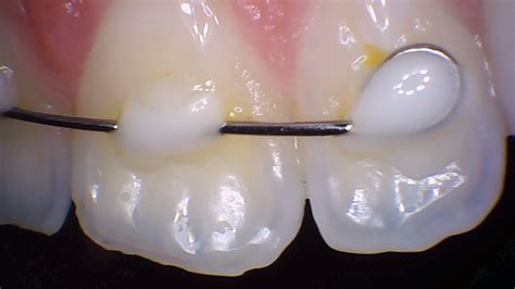 Perfectcam Intraoral Camera Ioc Snapshot