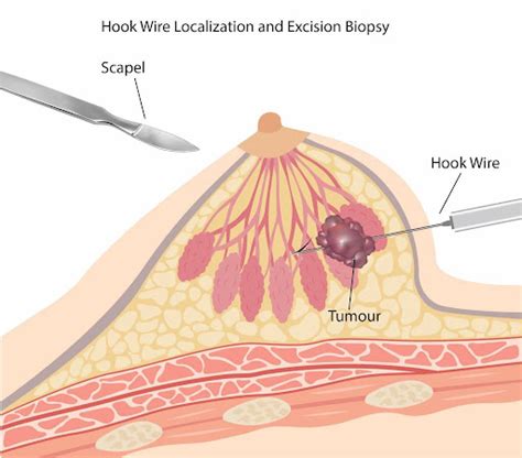 Hookwire Localization And Removal Of Cancerous And Abnormal Breast