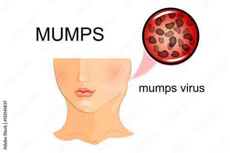 Mumps Diagram