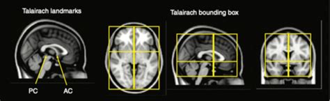 Lecture 5 Spatial Normalization Flashcards Quizlet