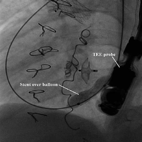 Demonstrates Fontan Baffle Puncture Inferior To Aso Device Using An Download Scientific Diagram