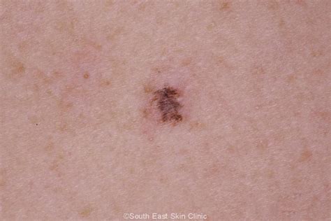 Different Names Of Moles