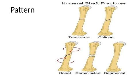 Fracture Of Humerus Shaft And Intercondylar Fracture Pptx