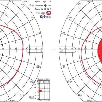 Case 1 Goldmann Visual Field Test Shows Constriction Of The Visual Download Scientific Diagram