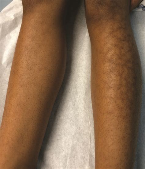 Hyperpigmentation Causes Treatments And Outlook Justinboey