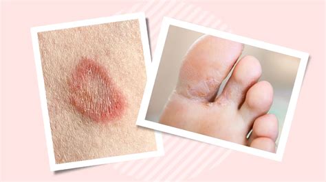 Fungal Skin Infections Symptoms Causes Diagnosis Treatment And