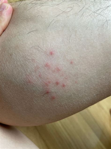 진드기에 물린 자국 일까요 지식in