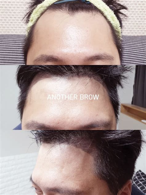 Another Brow M자이마 라인 반영구 남자분들에게 특히 많은 M자이마 아직두 가리고