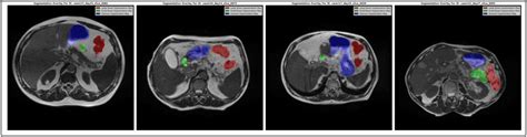 medical image segmentation using 🤗 huggingface and pytorch