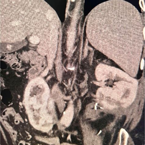 Computed Tomography Follow Up Revealed Normal Anatomical Findings Download Scientific Diagram