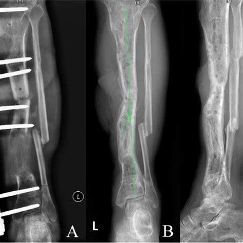 A 41 Year Old Male Patient With Right Tibial Bone Defect Caused By Download Scientific Diagram