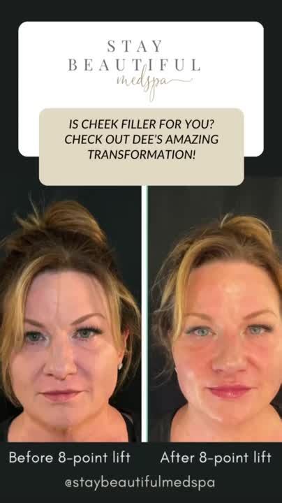 Wendy Vaughan On Linkedin Is Cheek Filler For You If You Are Someone That Has Deep Folds That Run…