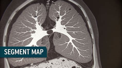 Effective Lung Segments On Ct A Practical Guide Pycad Your Medical Imaging Partner