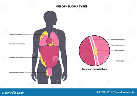 Pericardial Effusion Heart Vector Illustration 280424906