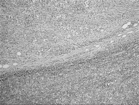 Intraparotid Lymph Node Adjacent To Tumor Lymphoplasmacytic Cell Download Scientific Diagram