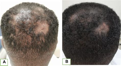 Dissecting Cellulitis Dc Of The Scalp A Case Report Ccid