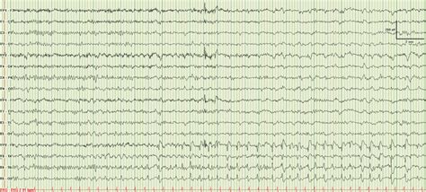 Eeg Fun Facts Seizures And Epilepsy Temporal Lobe Feb 16 2024