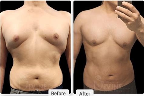Gynecomastia Surgery Vs Non Surgical Treatment Which Is Better