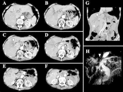 Proton Beam Therapy For Case 1 And Computed Tomography Images During Download Scientific