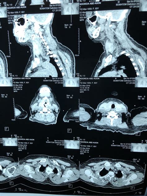 Large Retrosternal Multinodular Goiter Operated Via Cervical Incision March 2019 Dr Raad Al