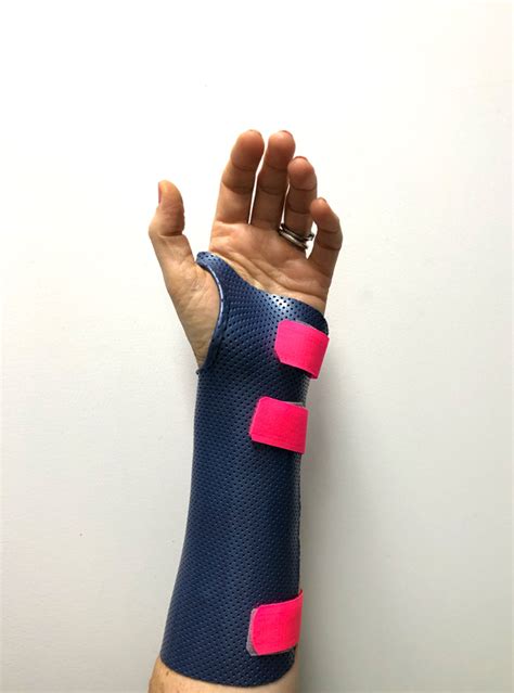 Fractured Wrist Cast