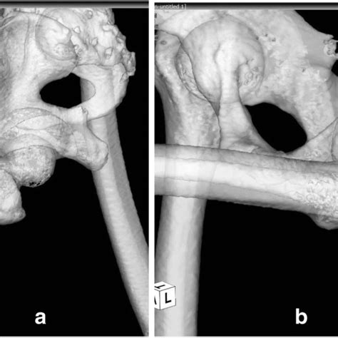 A The Impingement Angle Between The Anterior Acetabular Margin And The Download Scientific