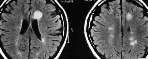 Tumefactive Ms With Enhancement Radiopaedia