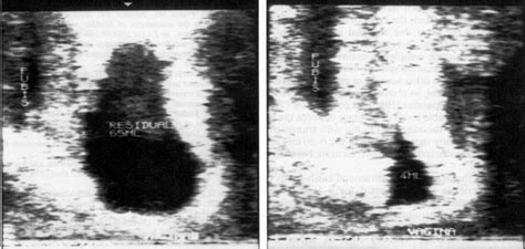 An Image Of Postvoid Residual Of 65ml By Transvaginal Ultrasound Download Scientific Diagram