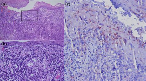 A Scaly Erythematous Patches On Both Areolas With Nipple Erosions